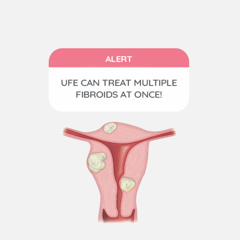UFE can treat multiple fibroids at once! - Fibroid Treatment Clinic